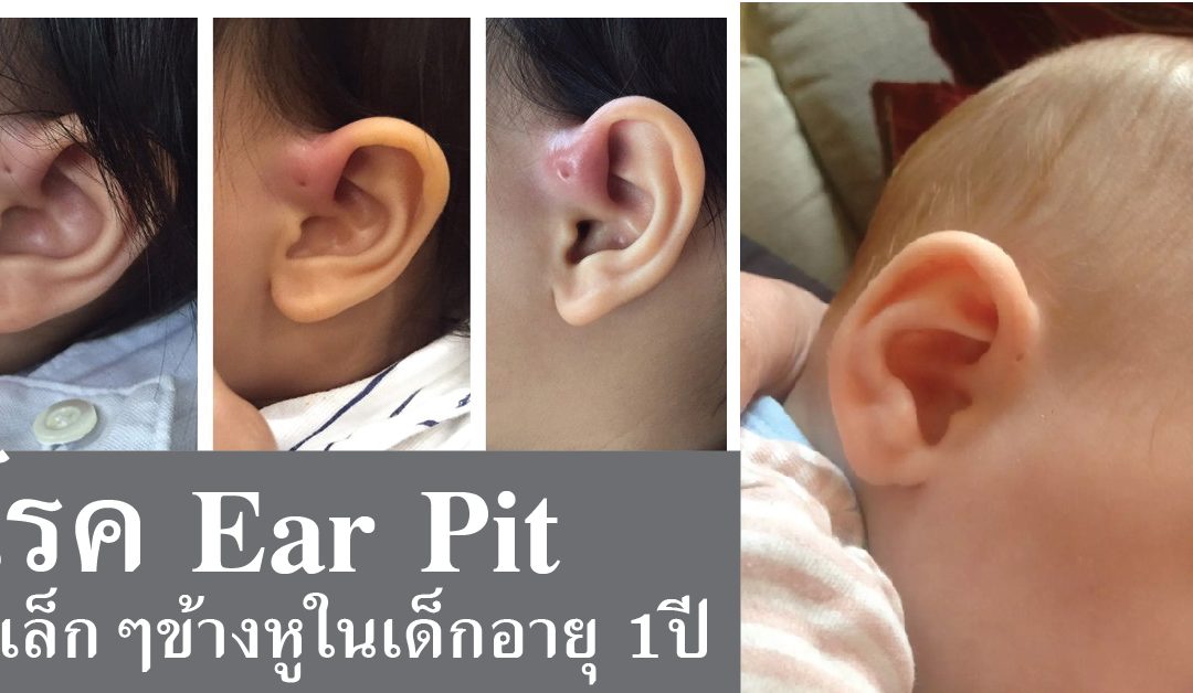 ภัยเงียบกับโรค Ear pit รูเล็กๆข้างหู ในเด็กอายุ 1 ปี | PinnSewing