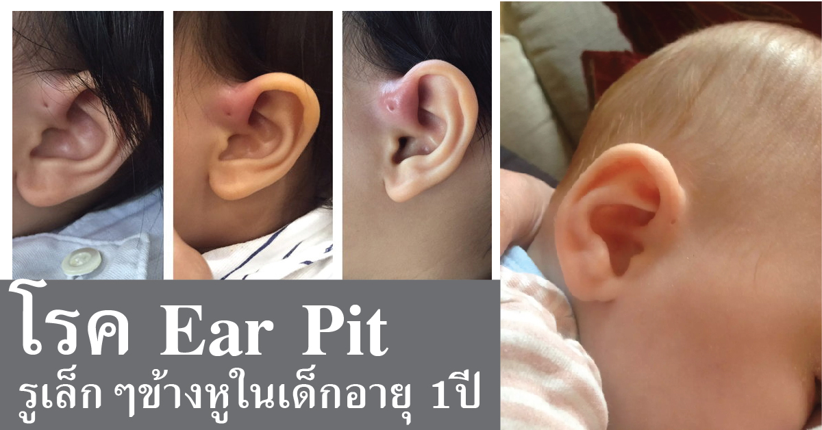 ภัยเงียบกับโรค Ear pit รูเล็กๆข้างหู ในเด็กอายุ 1 ปี – PinnSewing